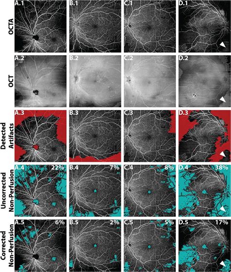 Examples Of Automatic Artifact Detection All Images Are Full Retinal Download Scientific