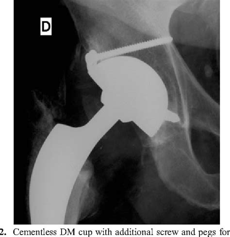 Figure 3 From Recurrence Of Dislocation Following Total Hip Arthroplasty Revision Using Dual