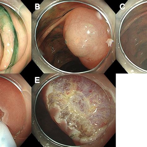 A Case Of Circumferential Submucosal Incision Prior To Endoscopic Download Scientific Diagram