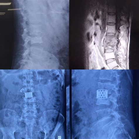 Anterior Debridement And Fusion With Stand Alone Titanium Mesh Cage In 38 Years Old Male Patient