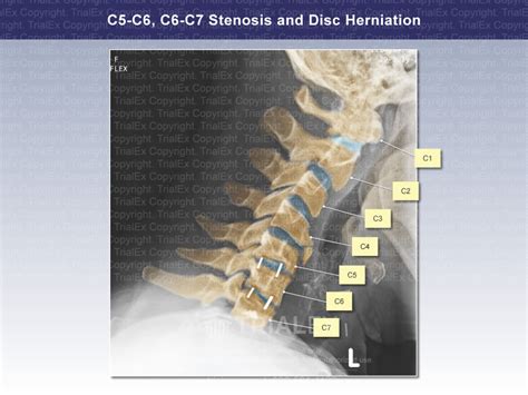 C5 C6 C6 C7 Stenosis And Disc Herniation Lateral View With Neck Flexion