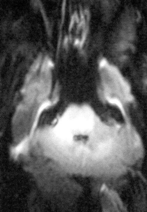 Dwi Both Trace A And Adc Map B Reveals High Signal Intensity Of Download Scientific