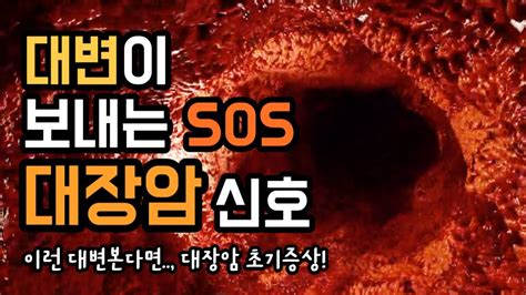 대장암 이런 대변을 본다면 대장암을 의심해보세요 대장암이 보내는 신호 10가지 총정리 Youtube