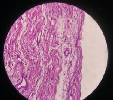 Figure 3 From A Case Of Anca Associated Vasculitis Presented With