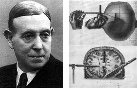 神外历史上的今天｜史上首例前额叶切断术 脑医汇