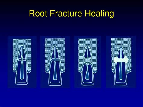Ppt Traumatic Injuries To The Teeth Powerpoint Presentation Free