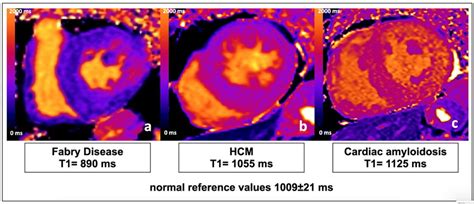 Mid Ventricular Short Axis View Of T1 Maps Modified Look Locker Download Scientific Diagram