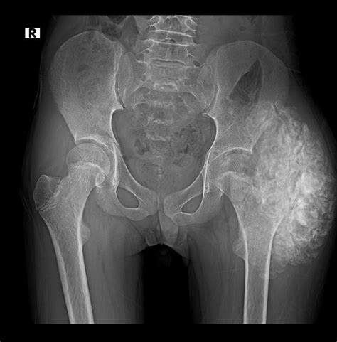 Radiopathological Features Of Tumoral Calcinosis Eurorad