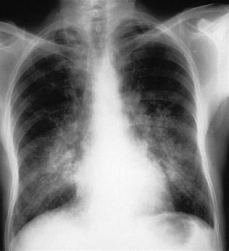 Diffuse Alveolar Hemorrhage Pulmonary Disorders Msd Manual