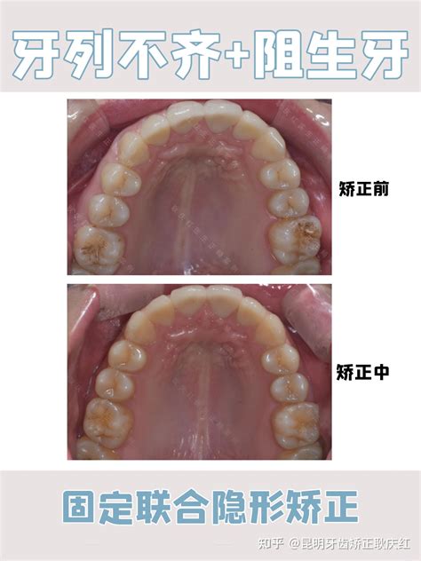 昆明牙齿矫正｜昆明正畸｜固定金属矫治器vs隐形矫正器（隐适美） 知乎