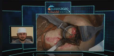Total Shoulder Arthroplasty With Inlay Glenoid With Dr Stephan Pill And Dr Chris Baker