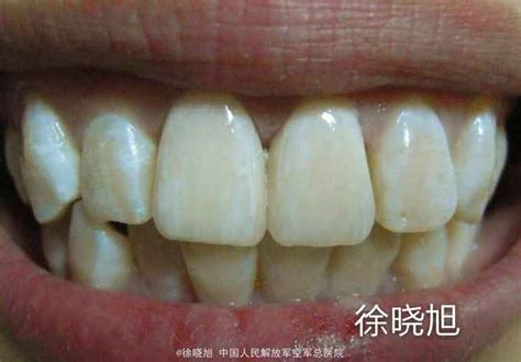上前牙外伤修复 医联