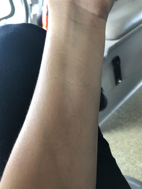 Weird Squiggly Lines On My Arm After A Nap R Mildlyinteresting