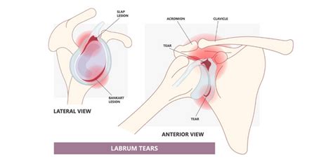 Posterior Superior Labrum Usa Shop