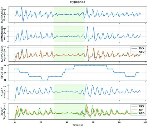Representative Example Of Signals Measured During A Hypopnea Event In A