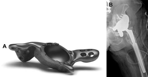 Component Selection In Revision Total Hip Arthroplasty Orthopedic Clinics