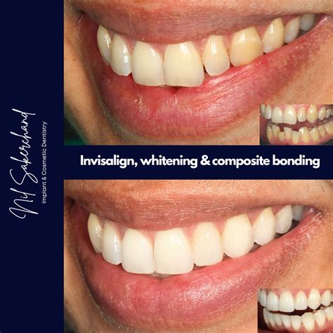 Case 7 Invisalign And Composite Bonding West Street Dental Practice Dentist In Leighton Buzzard