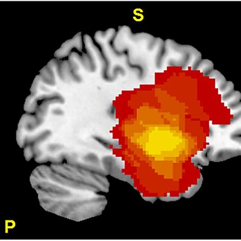 Patients Neuropsychometric Testing Scores Download Table