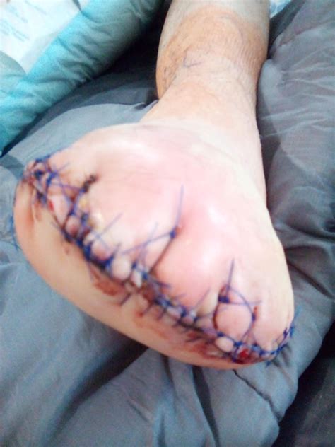 Frostbite Amputation Post Op R Surgery