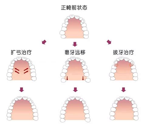 隐适美和时代天使矫正价格差多少，可以不拔牙吗 爱康健齿科