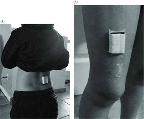 Attachment Sites On The Body For The Dual Axivity Ax3 Accelerometer Download Scientific