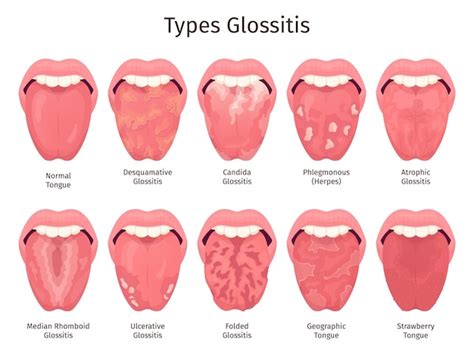 Glositis Tipos De Enfermedad De La Lengua Escarlata Boca Humana Dolor
