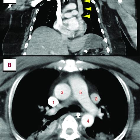 Chest Computed Tomography Coronal Chest Computed Tomography With