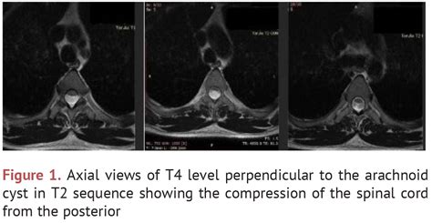 Thoracic Intradural Extramedullar Arachnoid Cyst In An Adult Case Report And Review Of The