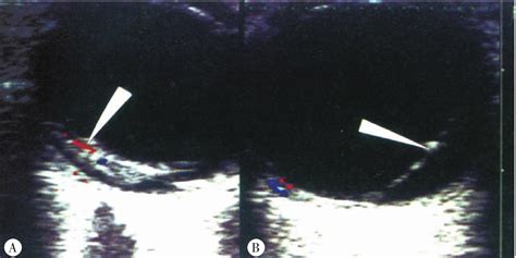 八、糖尿病性视网膜病变 医学教育 医学