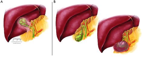 Gallbladder Volvulus A Normal Gallbladder B Anatomical Variant Of Download Scientific