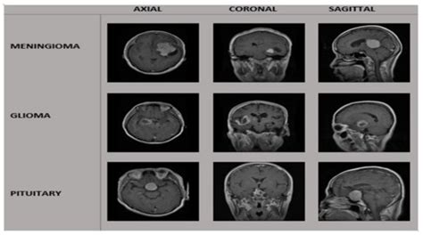 enhanced brain tumor classification using graph 56 off