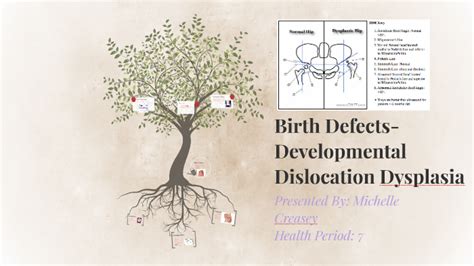 Birth Defects Developmental Dislocation Dysplasia By Michelle Creasey