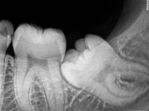 Impacted Wisdom Tooth Symptoms Causes And Treatment