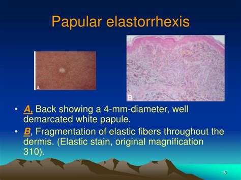 Ppt Elastic Tissue Disorders Powerpoint Presentation Id1023203