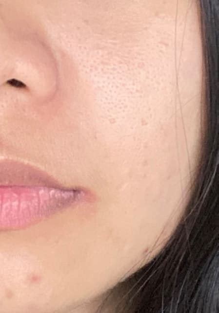 詢問 有人打過靚X紀的飛梭嗎 醫美板 Dcard
