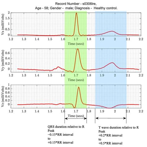 Timing Criteria For The Segmentation Of Qrs And T Wave Patterns In Ecg