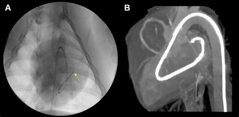 1 A Fluoroscopy Image Of The Cardiac Catheterization Performed On One