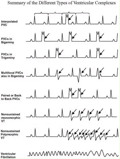 Pharmacology Different Types Of Ventricular Complexes 1interpolated Pvcs A Pvc Occurs Between