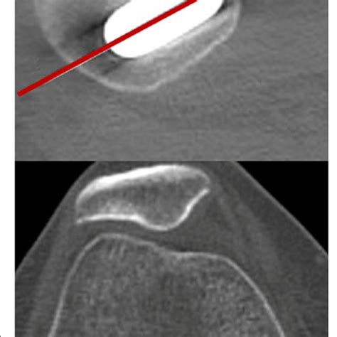 Measurement Of Stem Anteversion On Ct Scan The Anteversion Angle Was