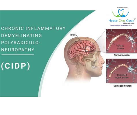 Cidp Symptoms Causes And Best Homeopathic Remedies For Treatment