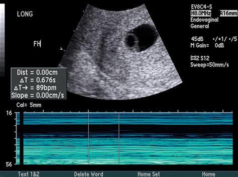 8 Week Ultrasound Heartbeat