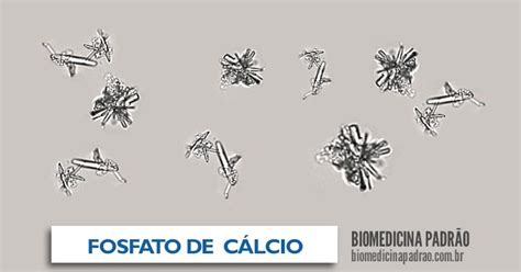 Principais Cristais Encontrados Na Urina Biomedicina Padrão