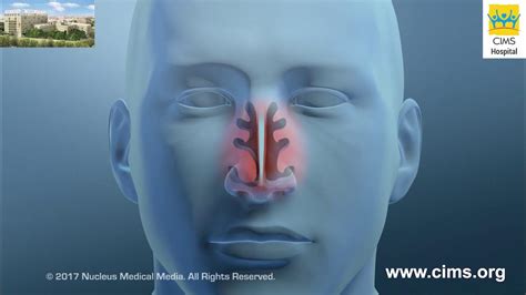 Nasal Turbinate Reduction Cims Hospital Youtube