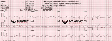 Stat Ecg Diagnoses Using Ectopy And Premature Ventricular Contractions