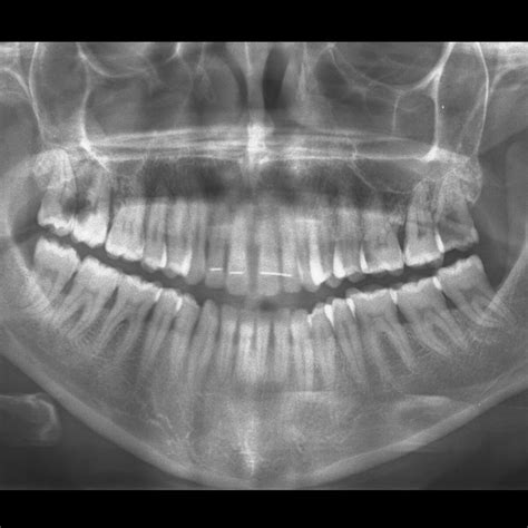 Panoramic Dental Xray Dataset Kaggle