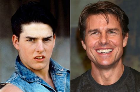 Tom Cruise Before And After Plastic Surgery 03 Celebrity Plastic Surgery Online