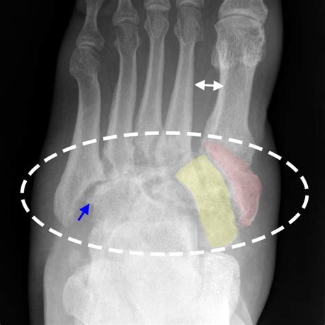 Lateral Dislocation Of The 2nd To 5th Tarsometatarsal Joints Severe Download Scientific