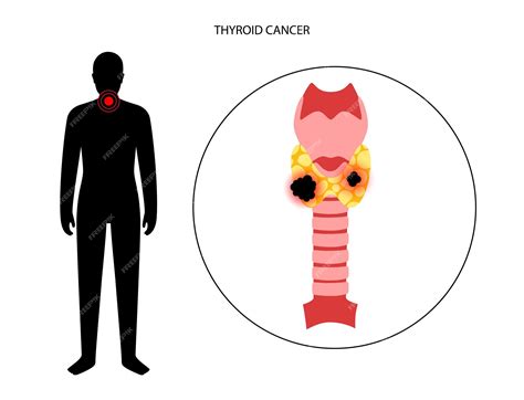 Premium Vector Thyroid Cancer Stages