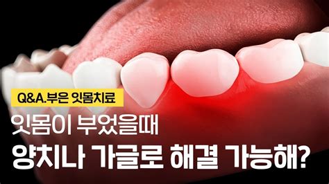 잇몸 부었을때 양치 가글 효과는 부은잇몸 원인 치료 대처법 Youtube