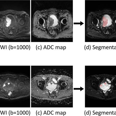 two representative cases of automatic segmentation of bladder cancer in